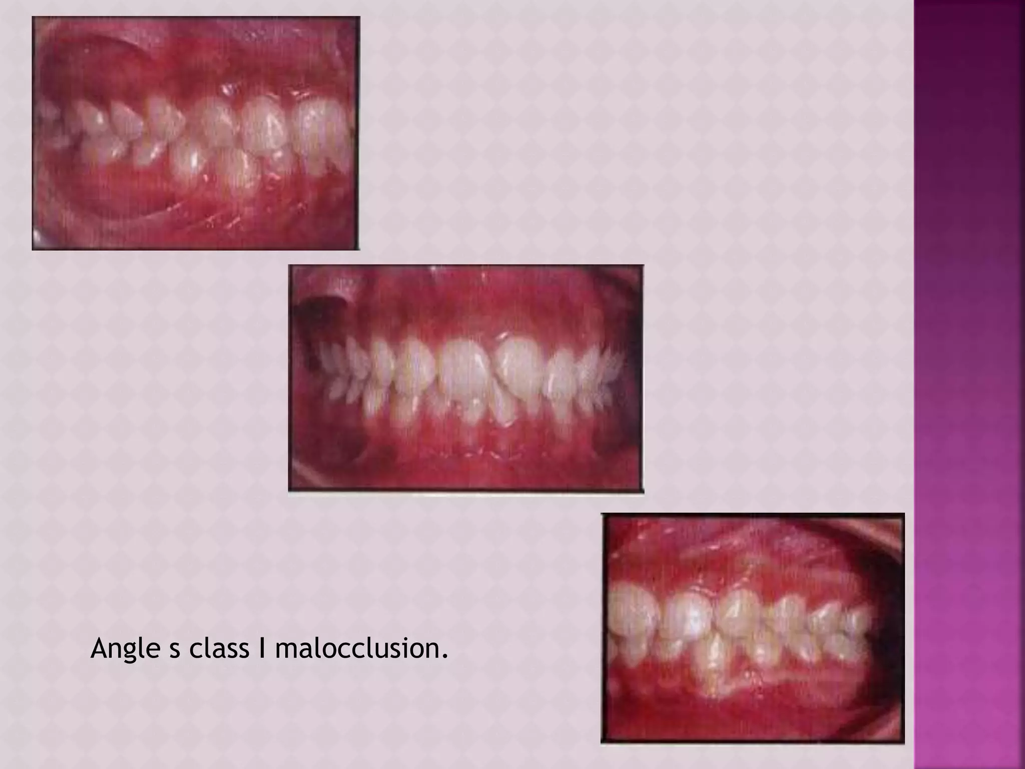 Classification ofmalocclusion | PPTX
