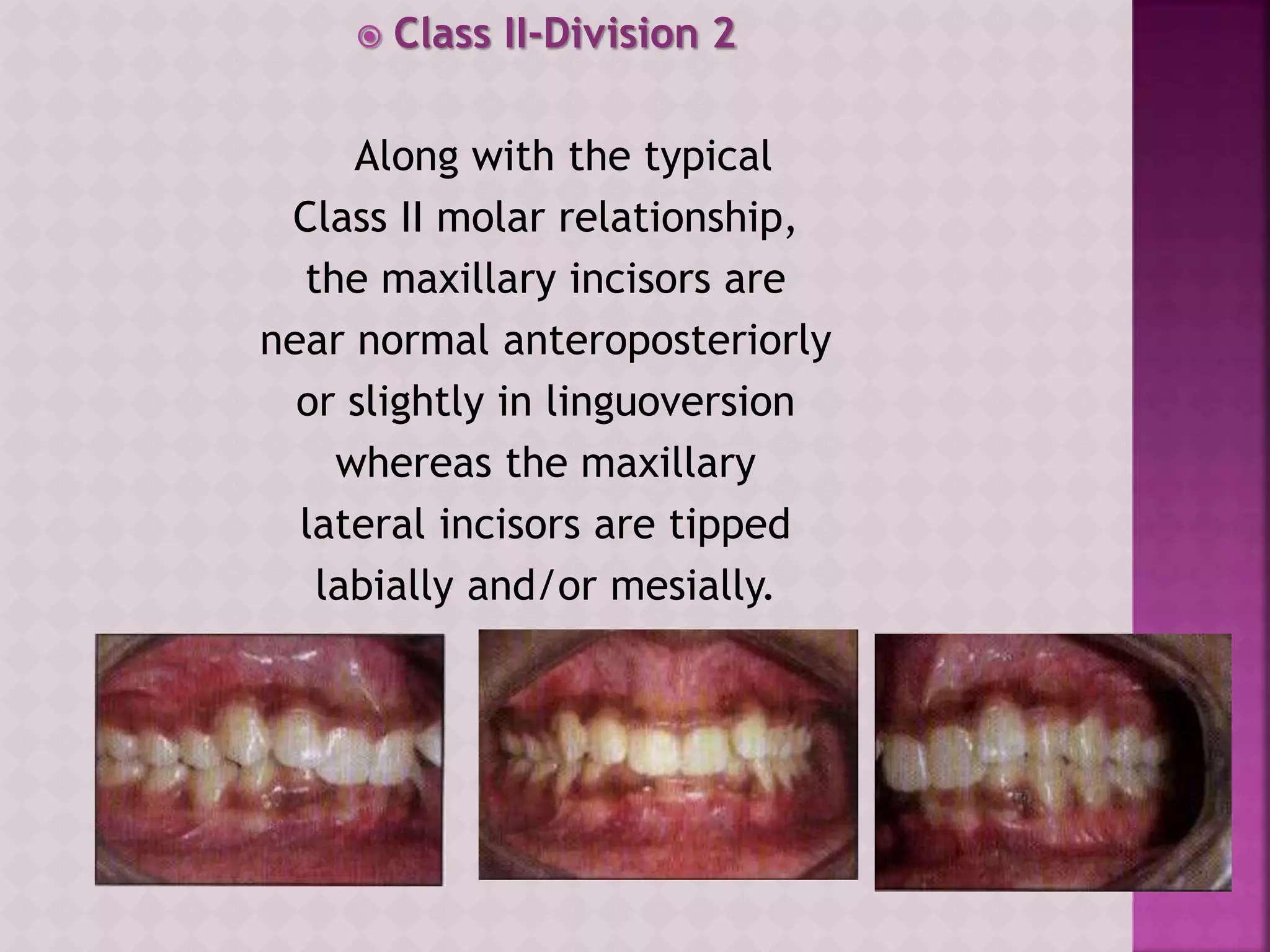 Classification ofmalocclusion | PPTX
