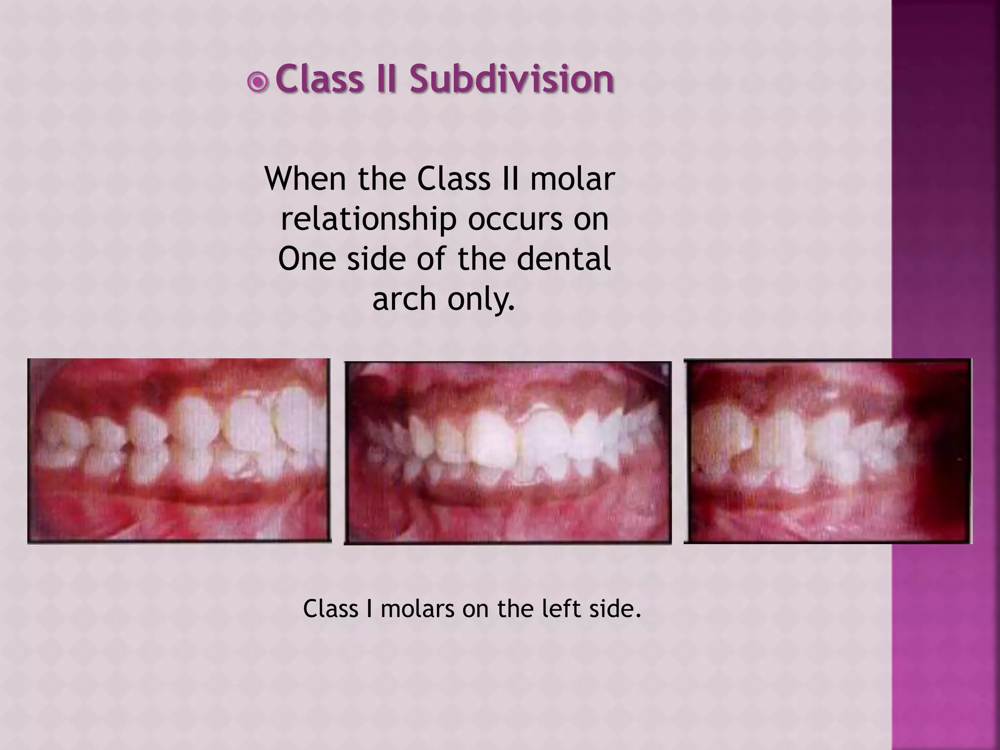 Classification ofmalocclusion | PPTX