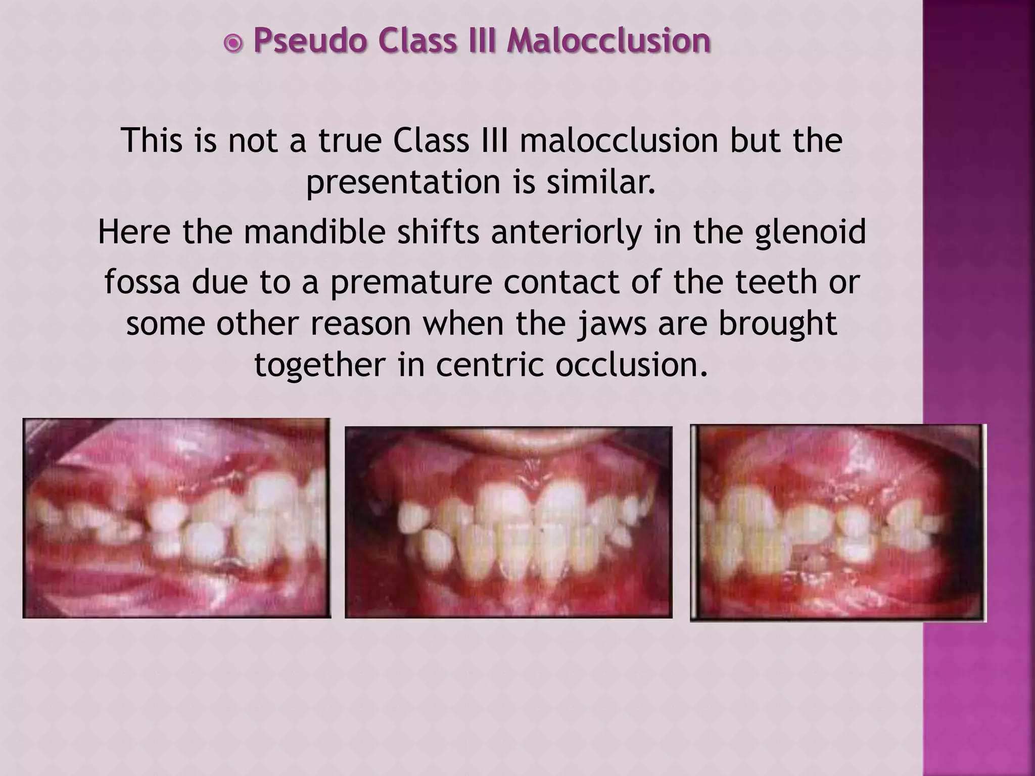 Classification ofmalocclusion | PPTX