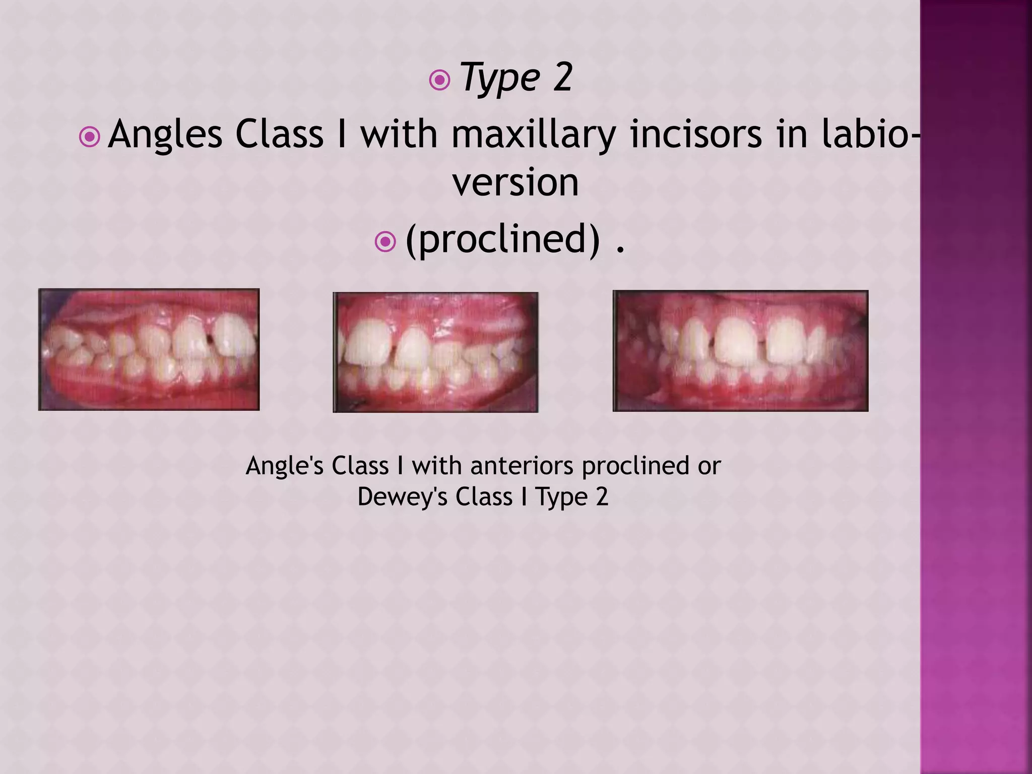Classification ofmalocclusion | PPTX