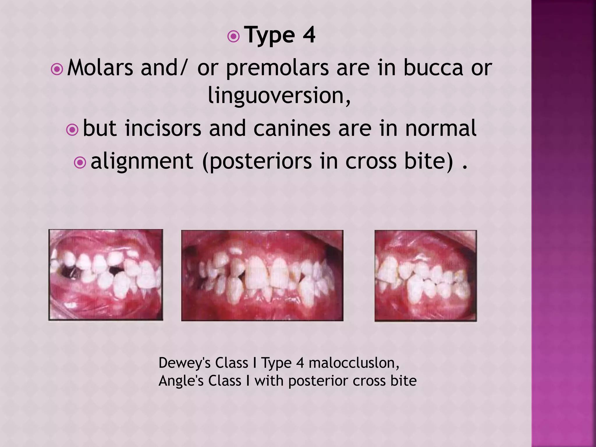 Classification ofmalocclusion | PPTX