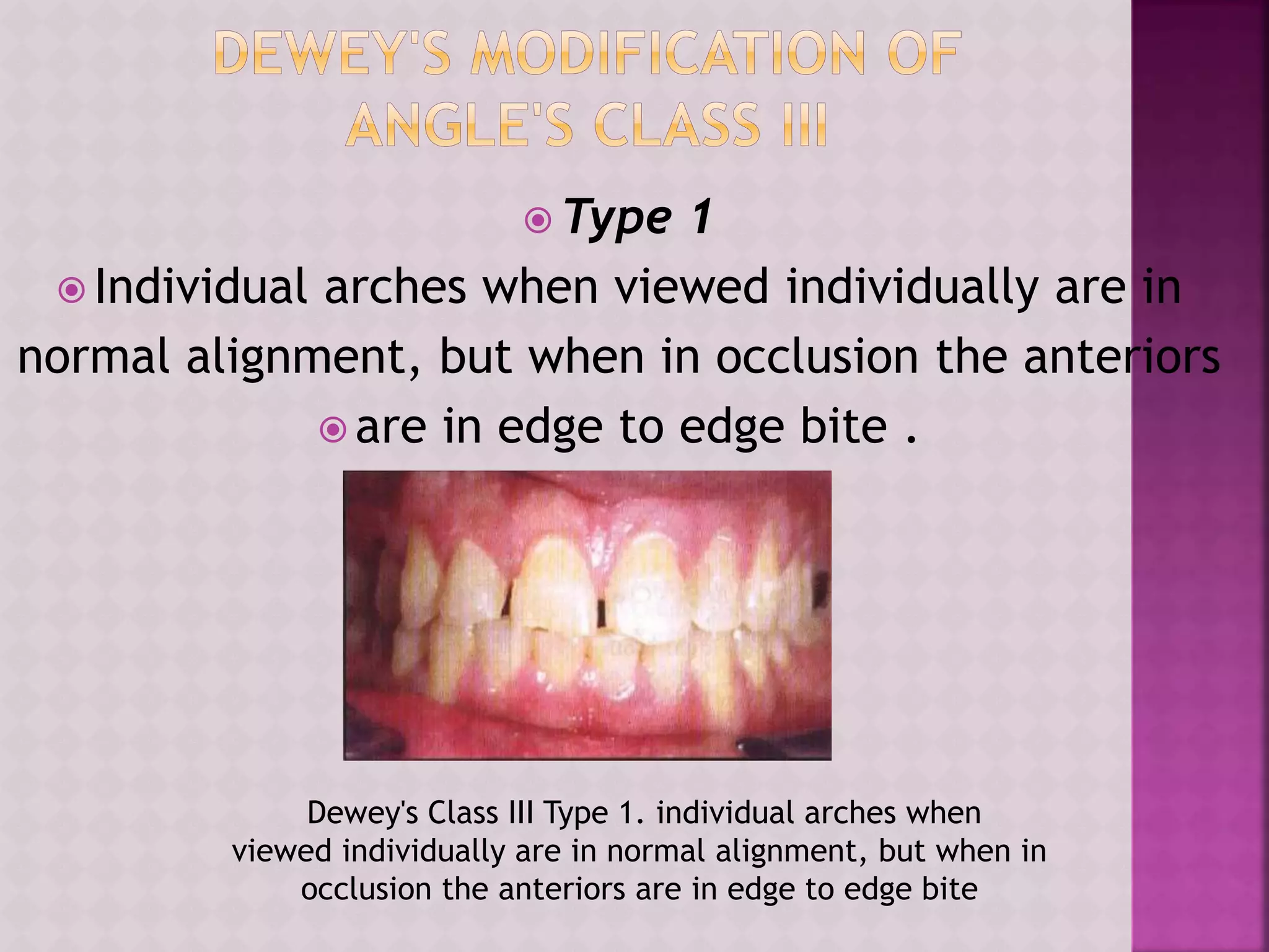 Classification ofmalocclusion | PPTX