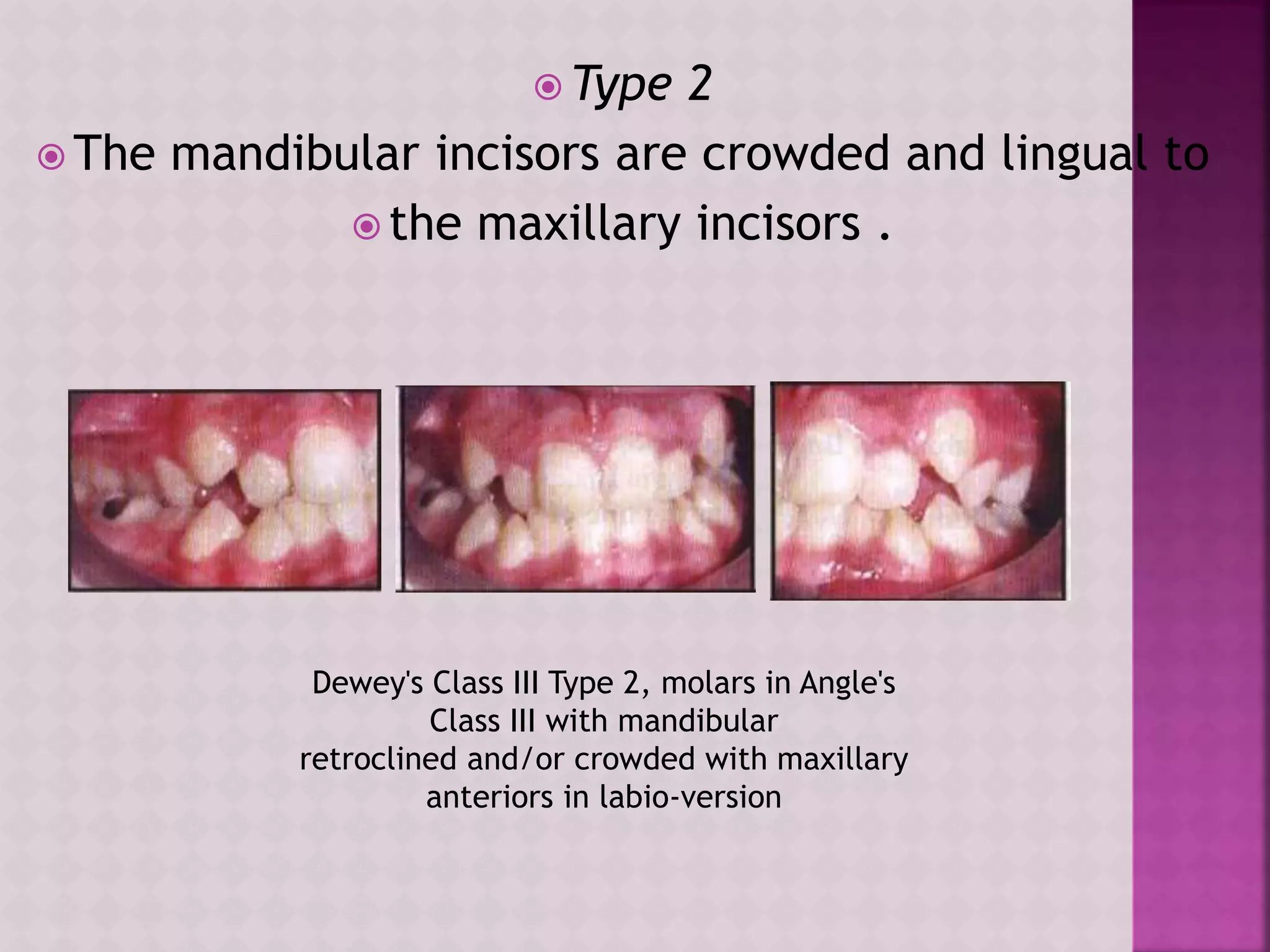 Classification ofmalocclusion | PPTX