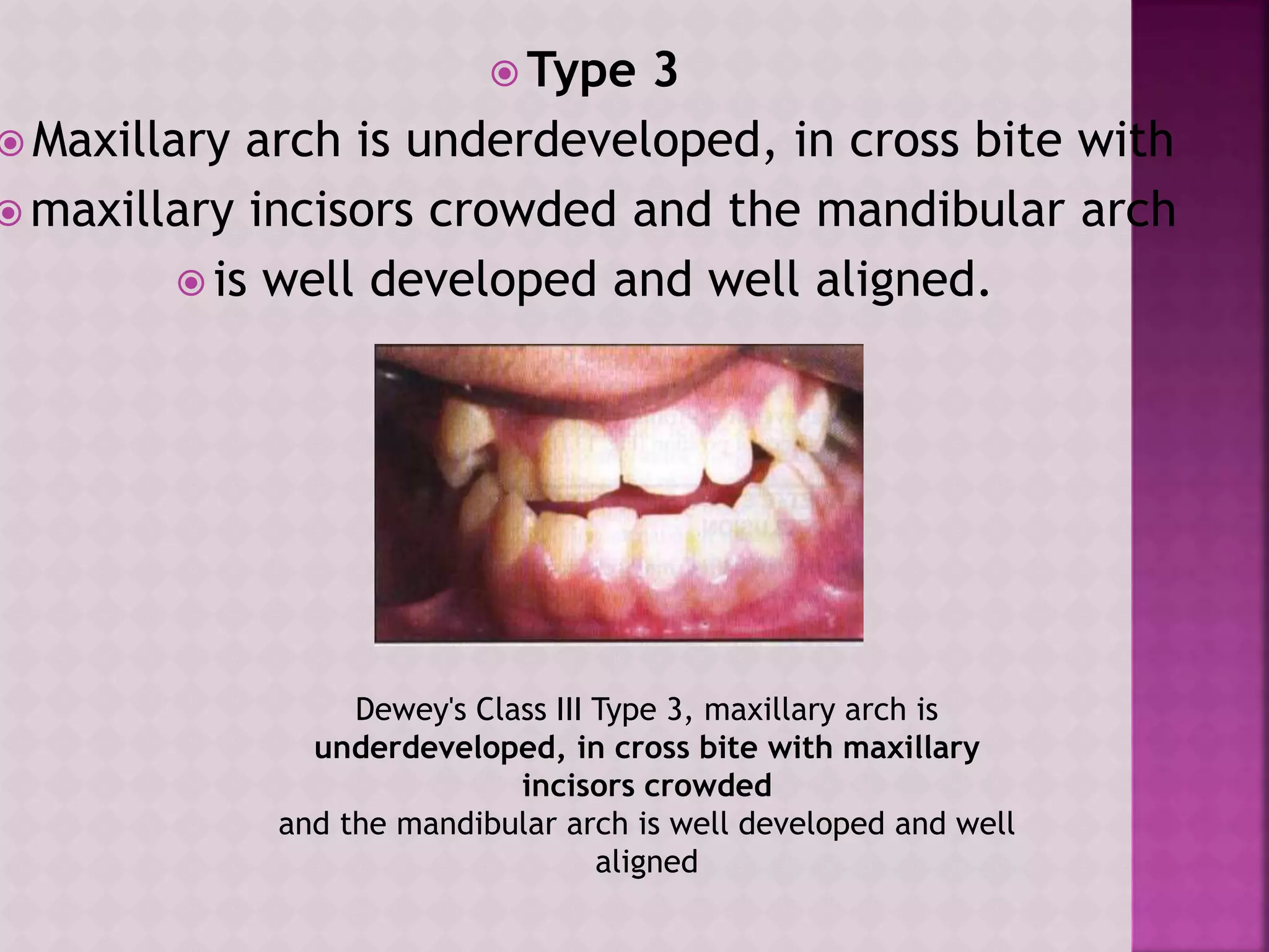 Classification ofmalocclusion | PPTX