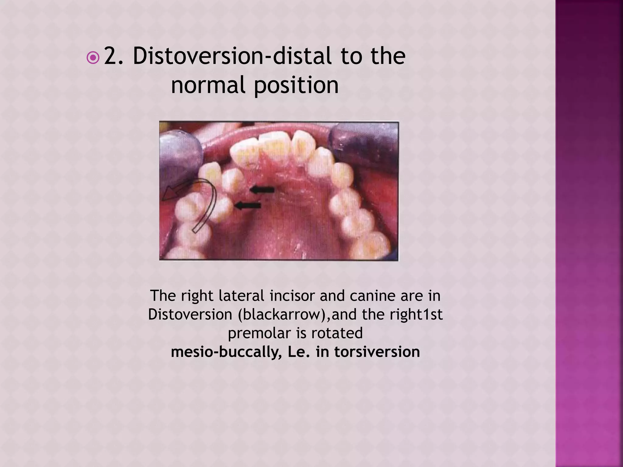 Classification ofmalocclusion | PPTX
