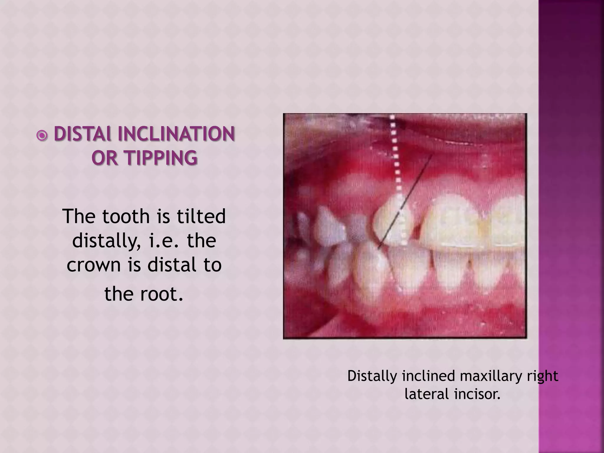 Classification ofmalocclusion | PPTX