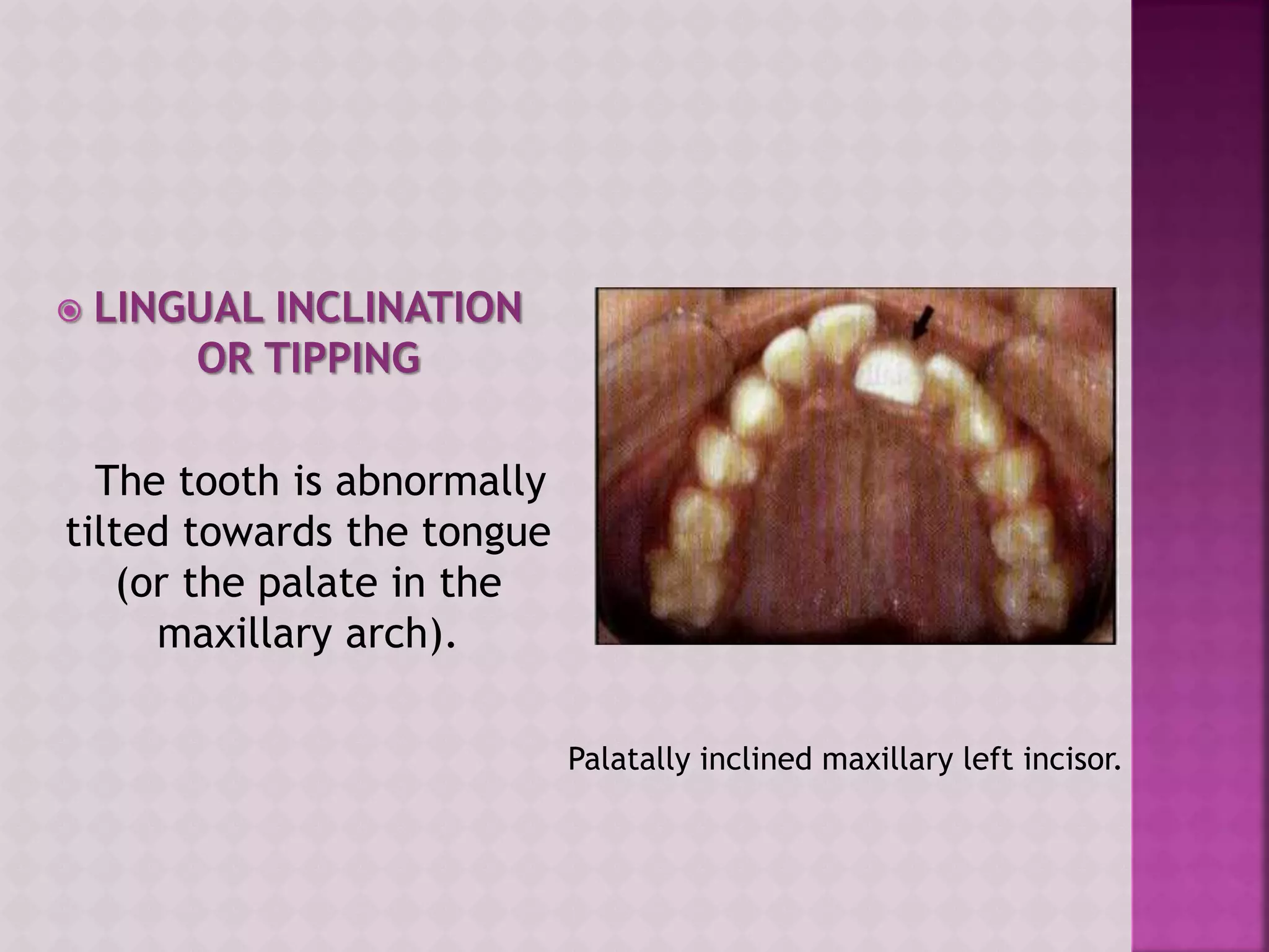 Classification ofmalocclusion | PPTX