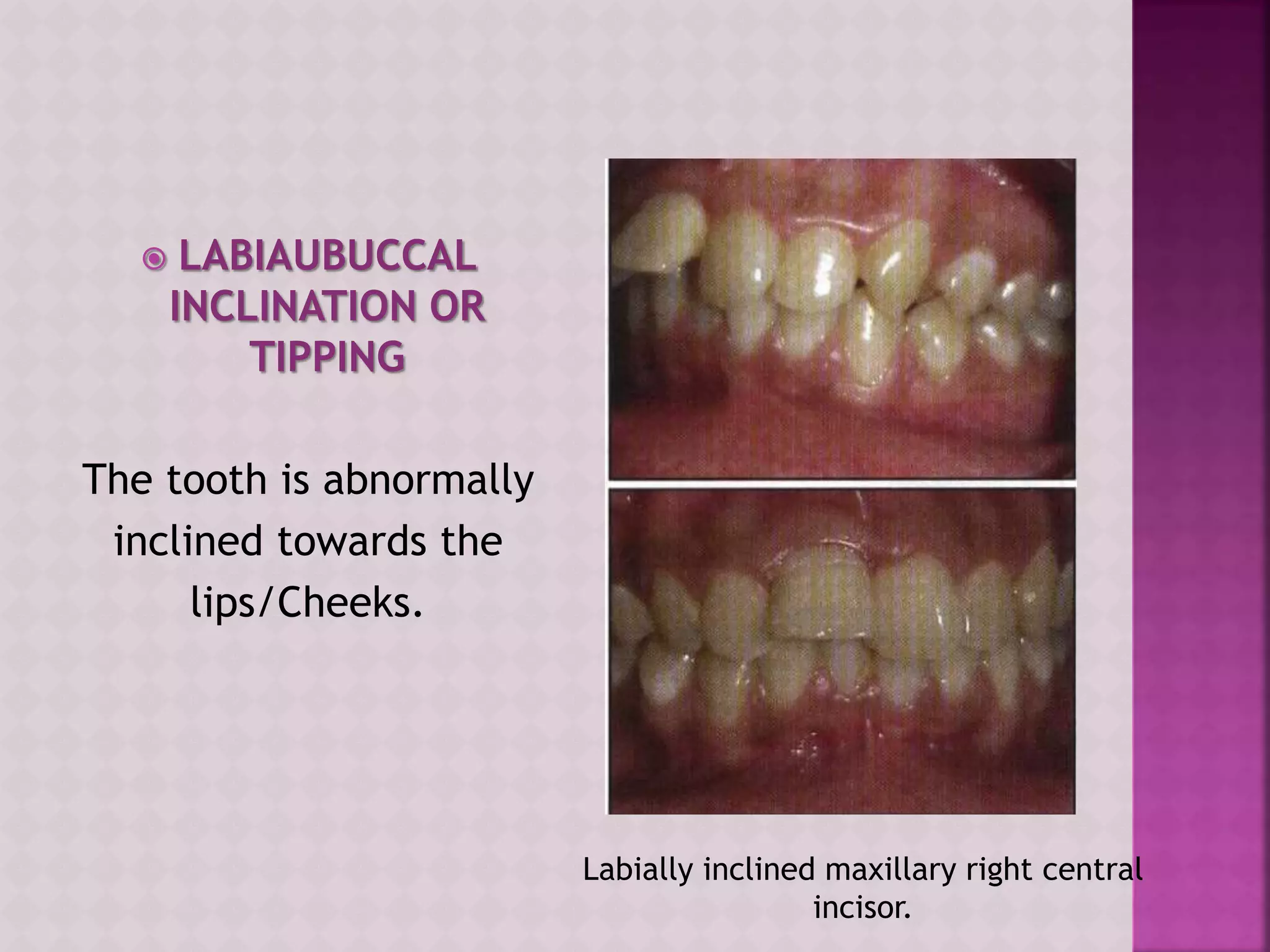 Classification ofmalocclusion | PPTX