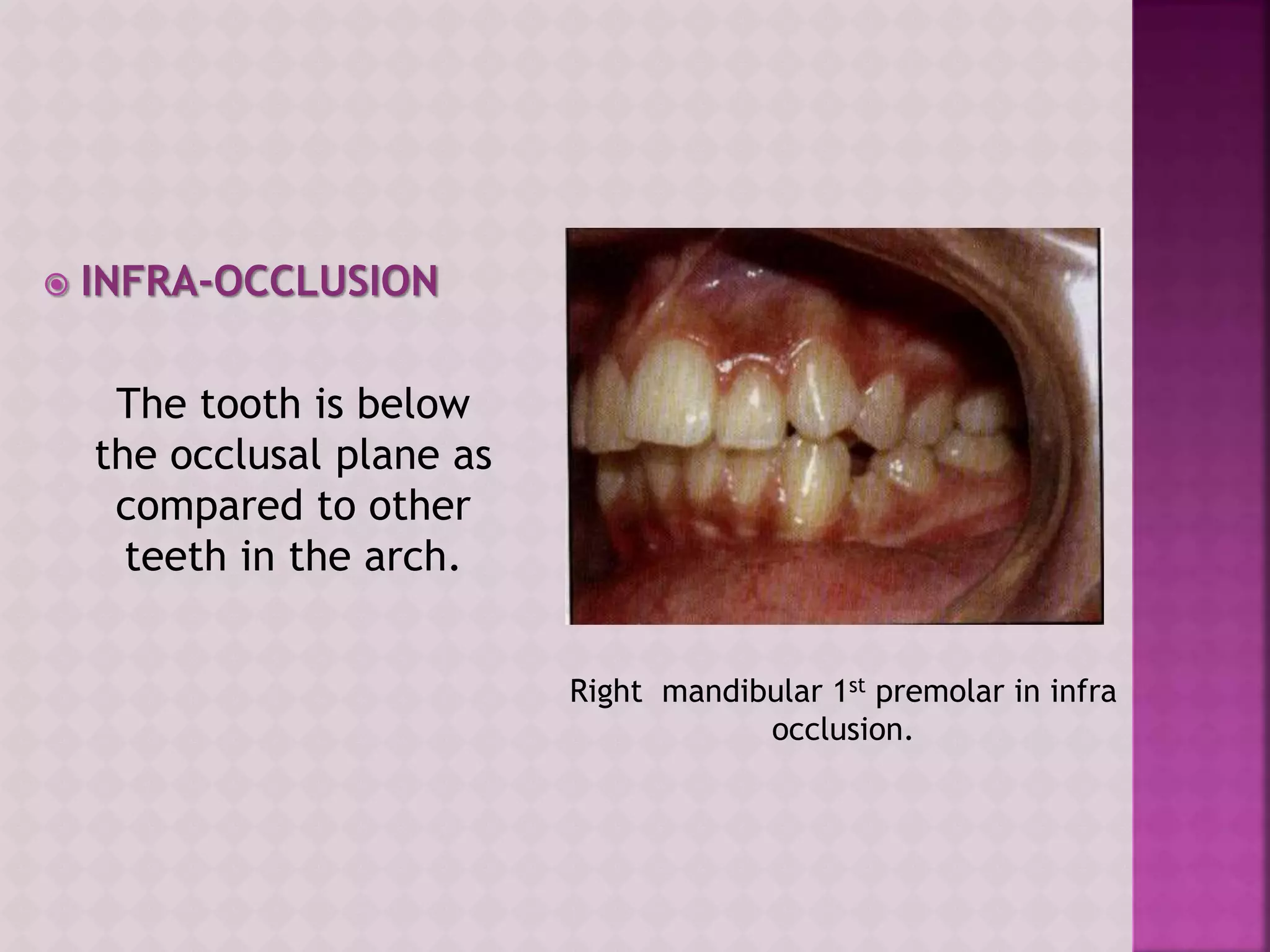 Classification ofmalocclusion | PPTX