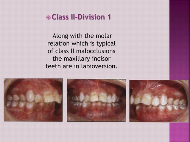 Classification ofmalocclusion | PPTX