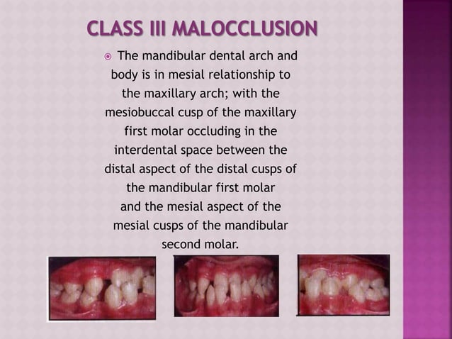 Classification ofmalocclusion | PPTX