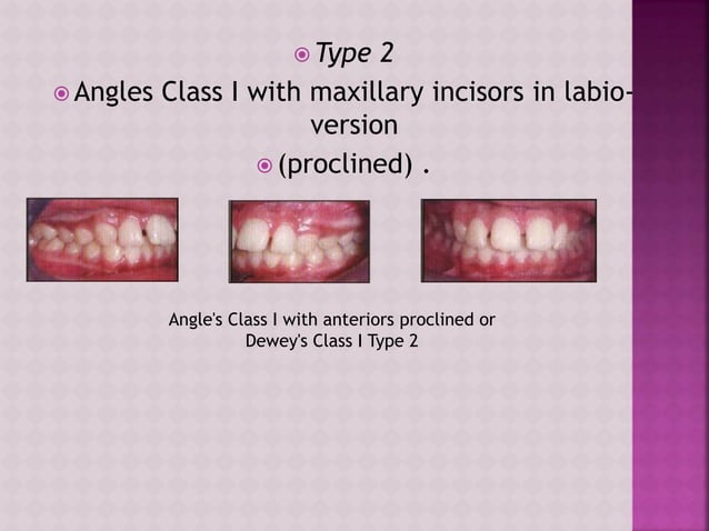 Classification ofmalocclusion | PPTX