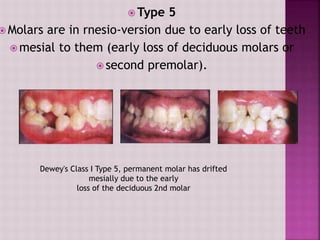 Classification ofmalocclusion | PPTX