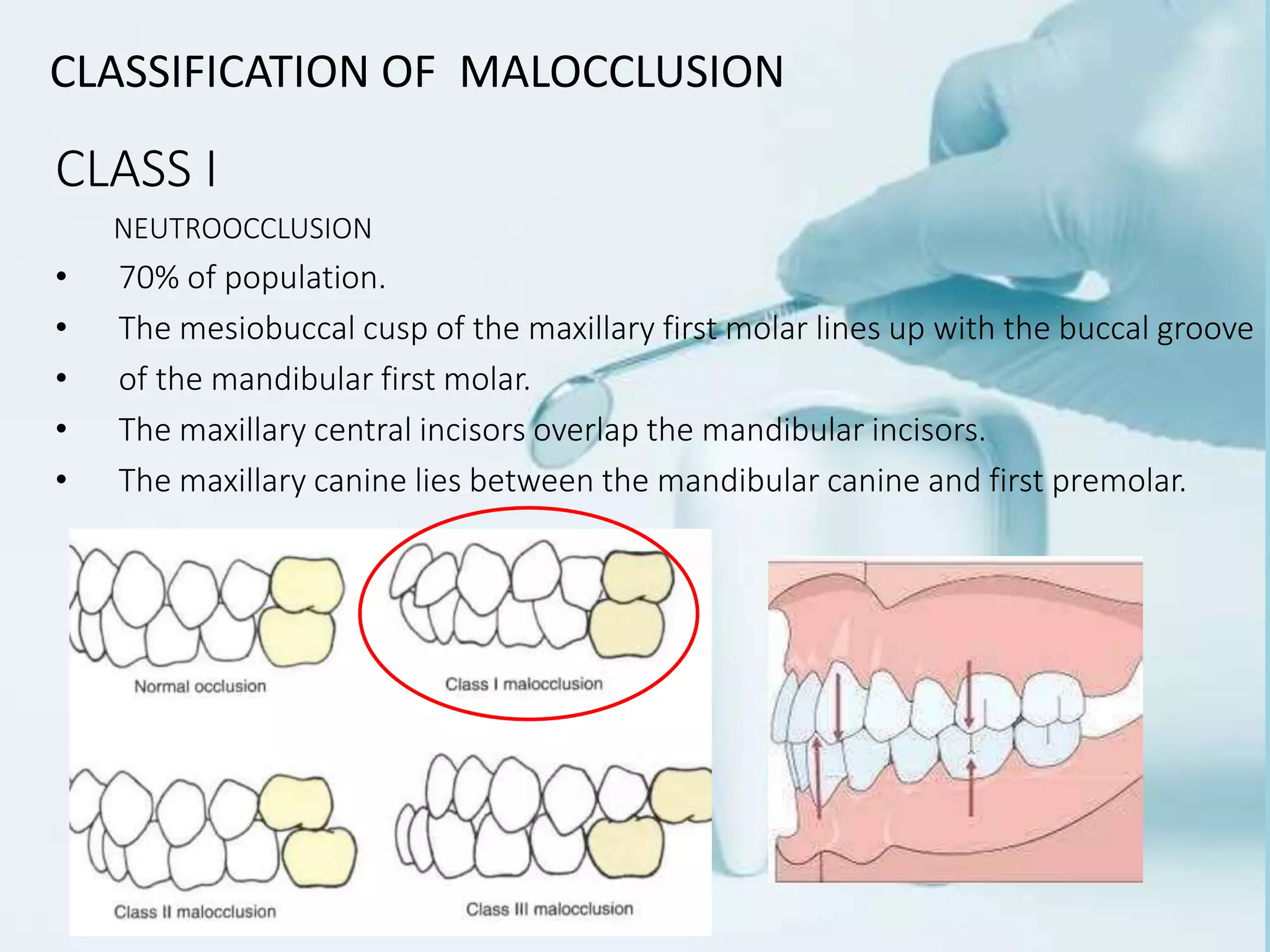 Classification of malocclusion | PPTX