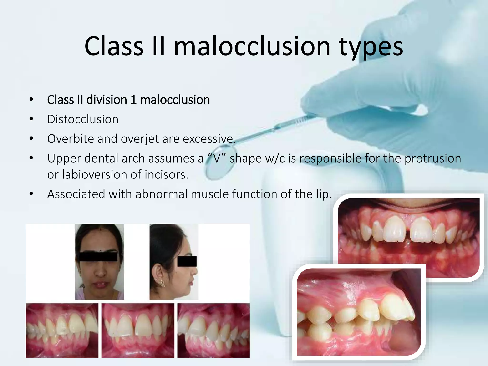 Classification of malocclusion | PPTX