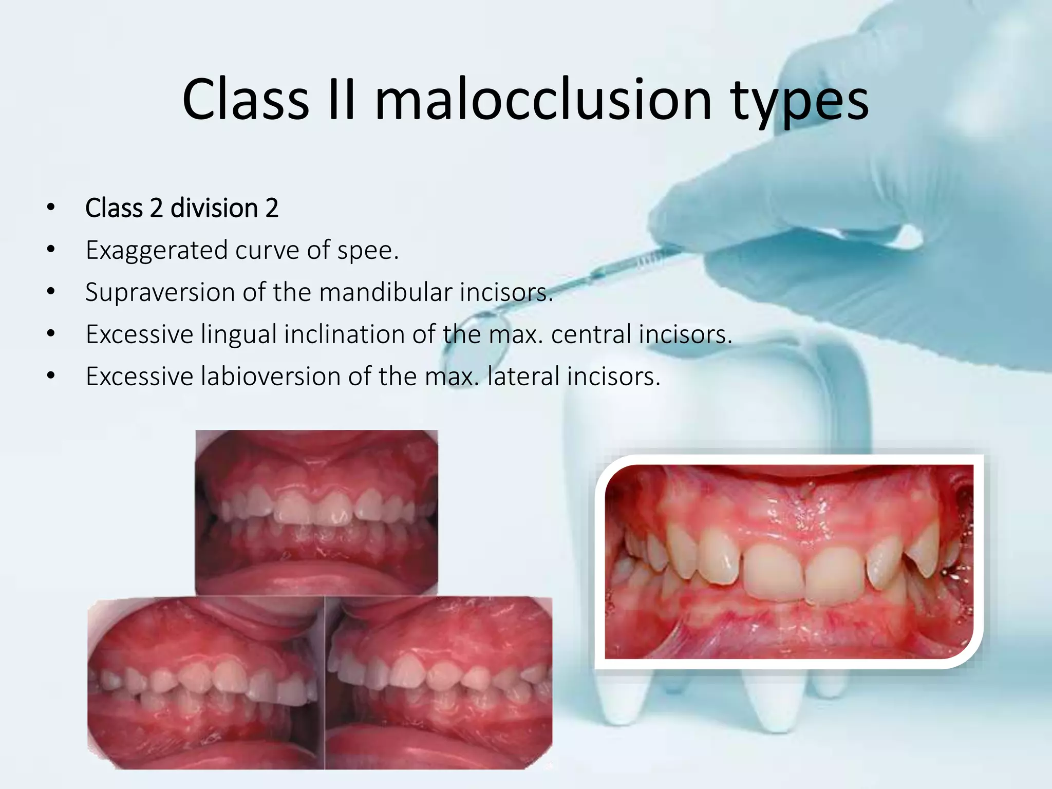 Classification of malocclusion | PPTX