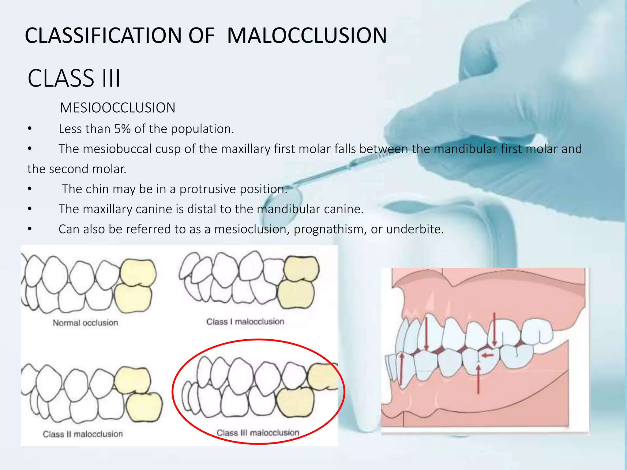 Classification of malocclusion | PPTX
