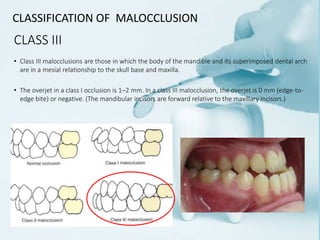 Classification of malocclusion | PPTX