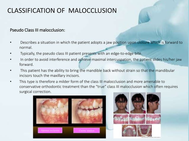 Classification of malocclusion | PPTX