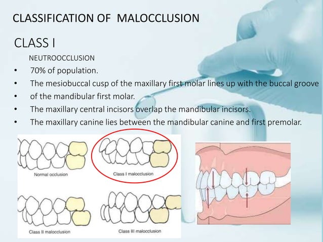 Classification of malocclusion | PPTX