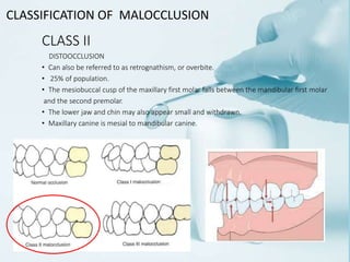 Classification of malocclusion | PPTX