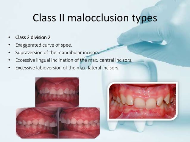 Classification of malocclusion | PPTX