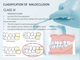 Classification of malocclusion | PPTX