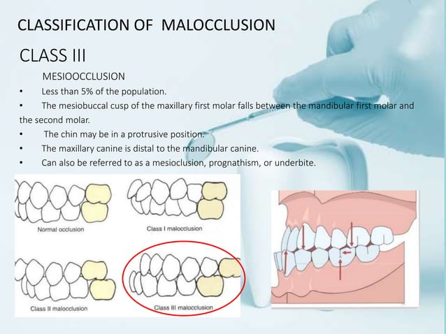 Classification of malocclusion | PPTX