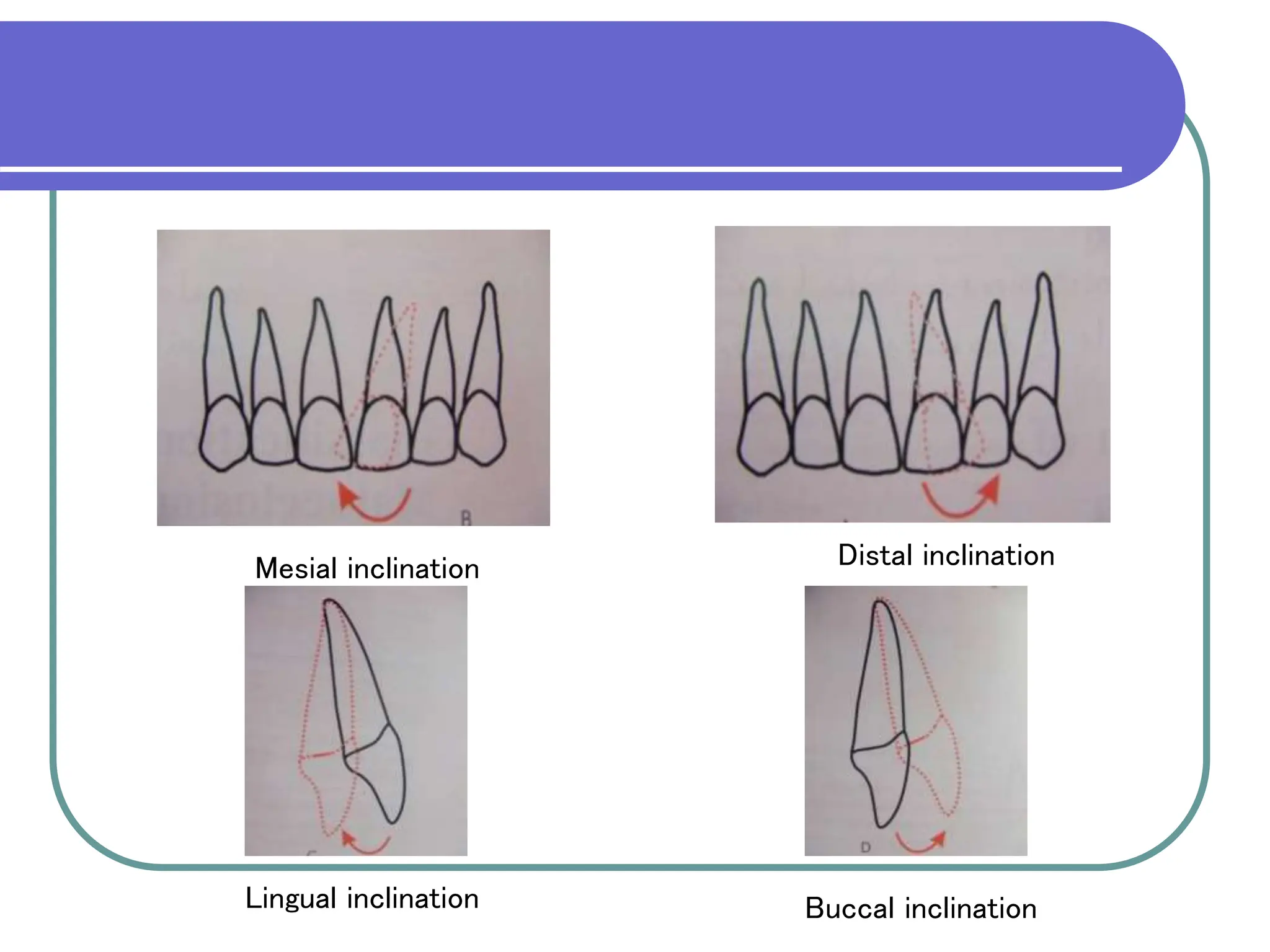 CLASSIFICATION OF MALOCCLUSION.ppt