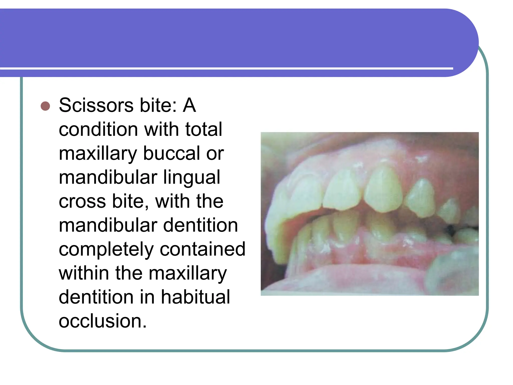 CLASSIFICATION OF MALOCCLUSION.ppt