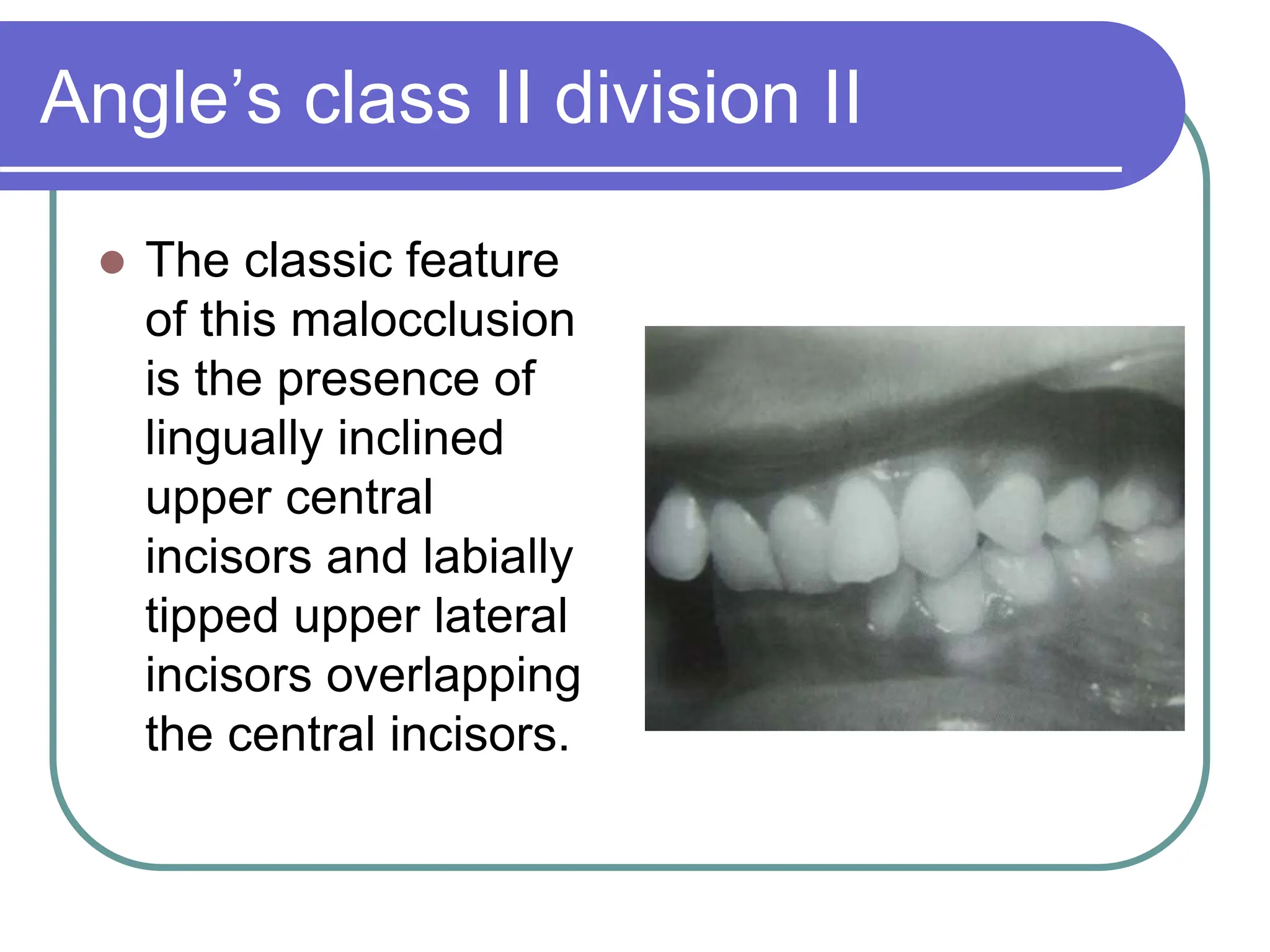 CLASSIFICATION OF MALOCCLUSION.ppt