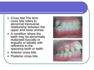 CLASSIFICATION OF MALOCCLUSION.ppt