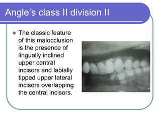 CLASSIFICATION OF MALOCCLUSION.ppt