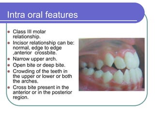 CLASSIFICATION OF MALOCCLUSION.ppt