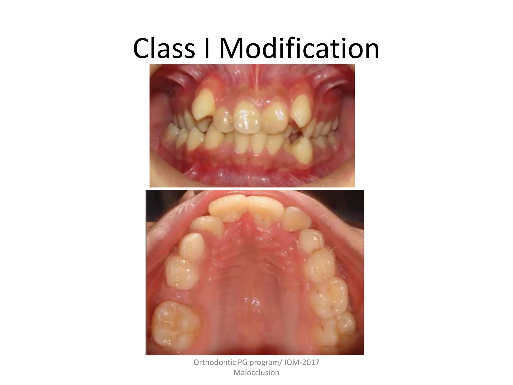 Classification of malocclusion.pptx