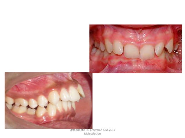 Classification of malocclusion.pptx