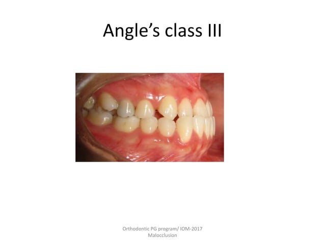 Classification of malocclusion.pptx