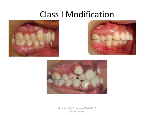 Classification of malocclusion.pptx