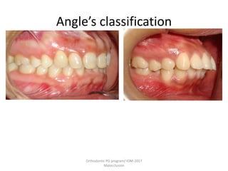 Classification of malocclusion.pptx