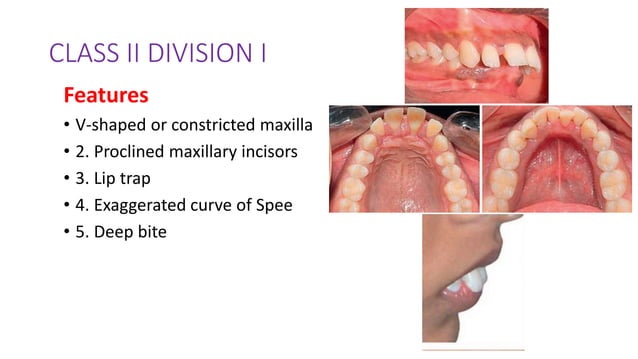 classification of malocclusion in detail.pptx | Dental Health ...