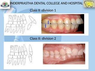 CLASSIFICATION OF Malocclusion skeletal and dental | PPTX