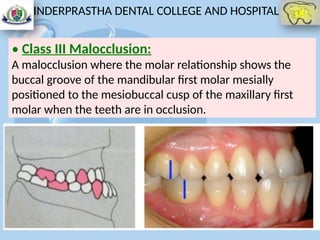 CLASSIFICATION OF Malocclusion skeletal and dental | PPTX