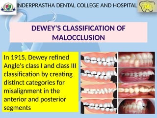 CLASSIFICATION OF Malocclusion skeletal and dental | PPTX