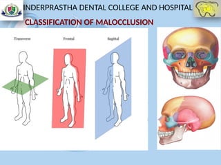 CLASSIFICATION OF Malocclusion skeletal and dental | PPTX