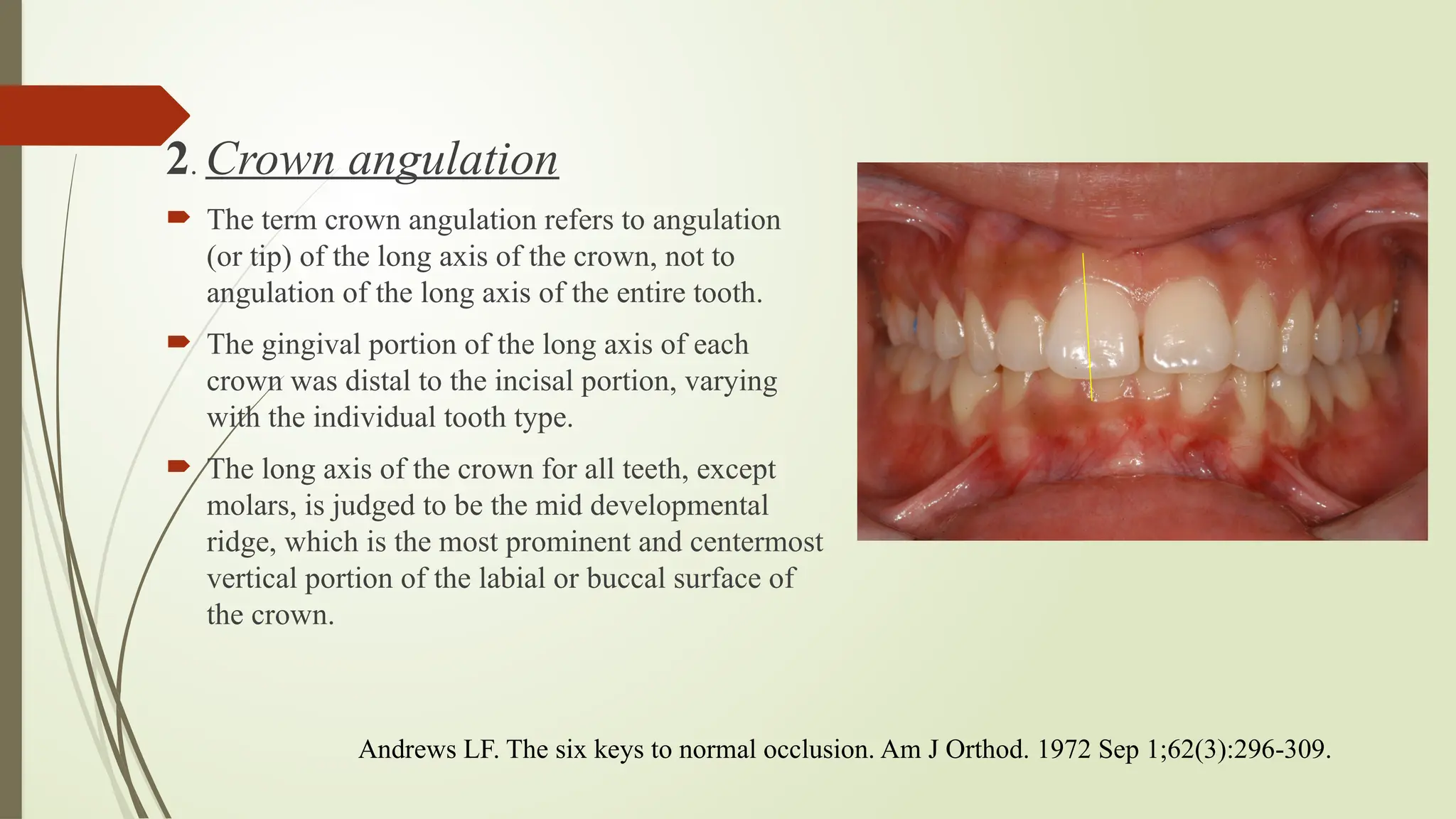 CLASSIFICATION OF MALOCCLUSION in orthodontics | PPTX