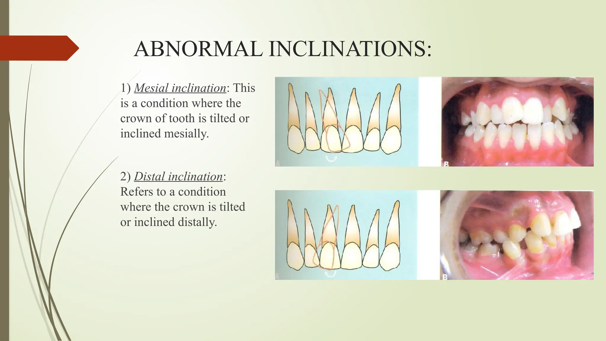CLASSIFICATION OF MALOCCLUSION in orthodontics | PPTX