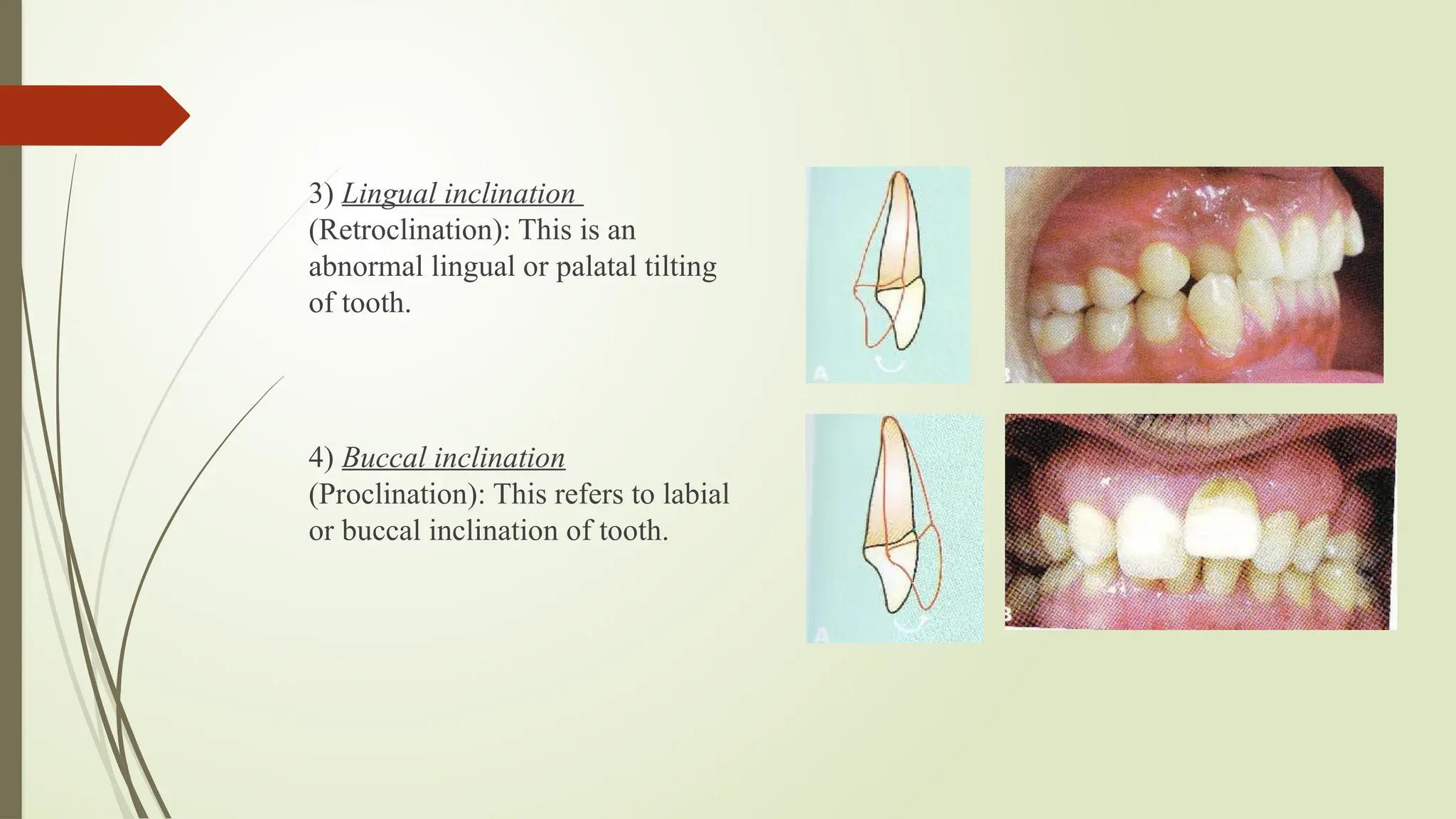 CLASSIFICATION OF MALOCCLUSION in orthodontics | PPTX