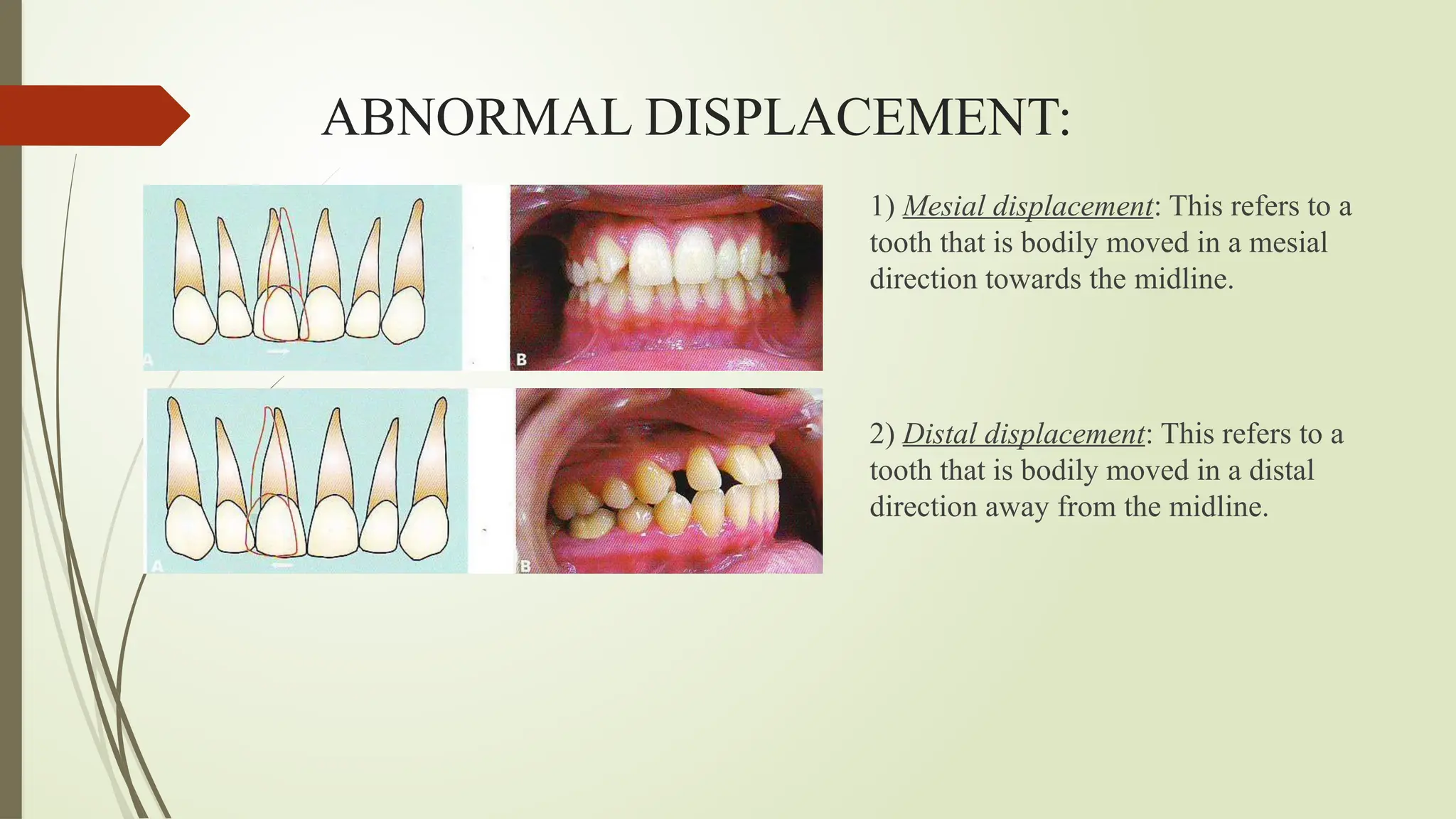 CLASSIFICATION OF MALOCCLUSION in orthodontics | PPTX