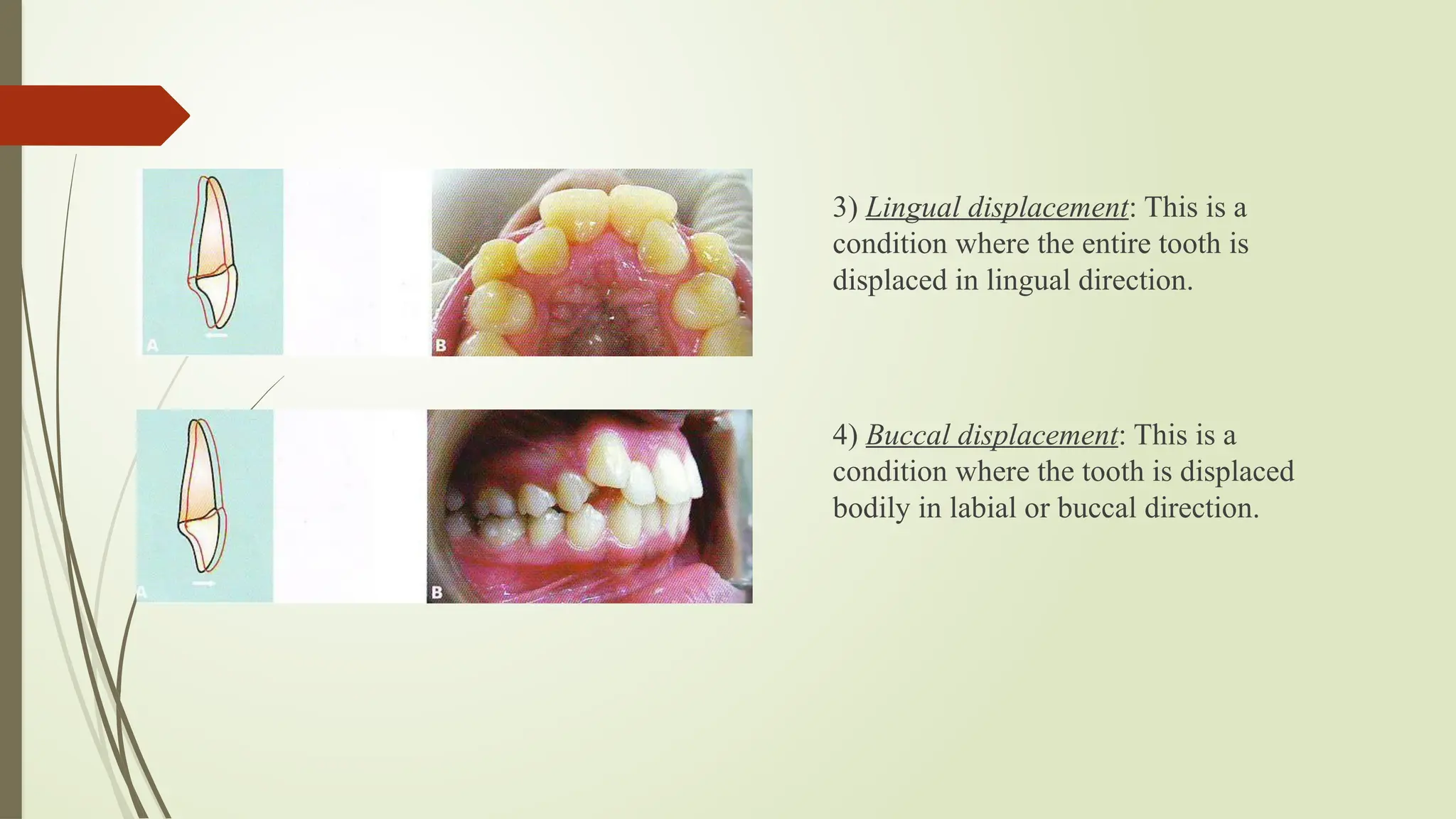 CLASSIFICATION OF MALOCCLUSION in orthodontics | PPTX